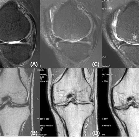 Surgical Procedure For Microfracture Followed By Biomembrane Cover Download Scientific Diagram