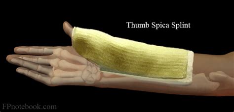 Scaphoid Fracture Splint