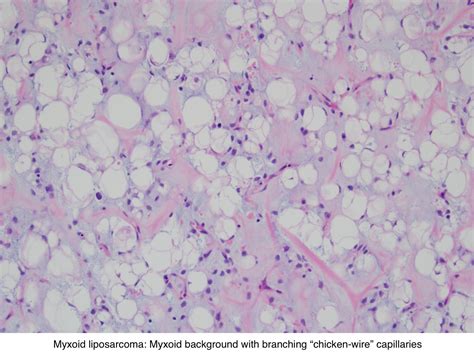 Pathology Outlines Liposarcoma