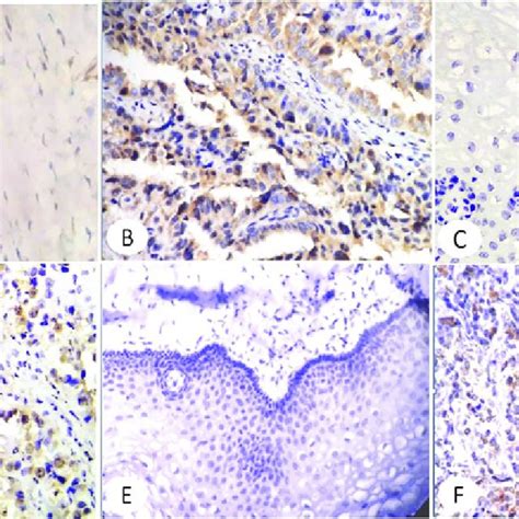 The Profile Of E6 Hpv P53 And P16ink4a Expression In Cervical Normal