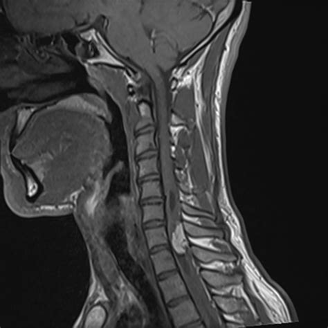 Spinales Hämangioblastom Pacs