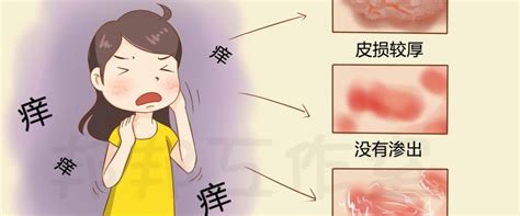 湿疹怎么治好得快？沈阳专业治湿疹的医院选哪家 — 神奇养生网