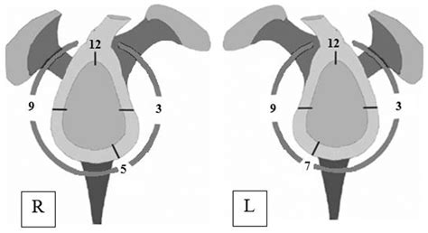 Figure 1 From Superior And Anterior Glenoid Labral Tears Are Associated With Increased
