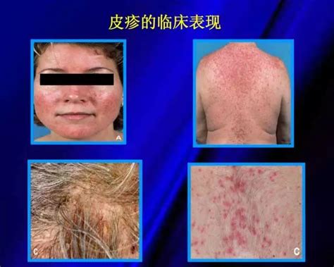 抗肿瘤靶向药出现皮疹不良反应也未必是坏事 治疗