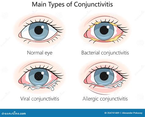 Main Types Conjunctivitis Diagram Medical Science Stock Illustration