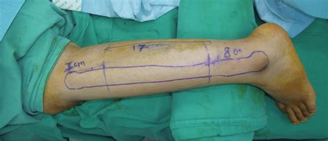 Fibula Bone Graft Supporting Failed Posterior Rod Implants In Thoracic