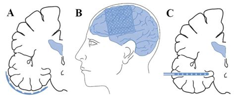 Intracranial Eeg Electrodes A Strip Electrode Targeting The Download Scientific Diagram