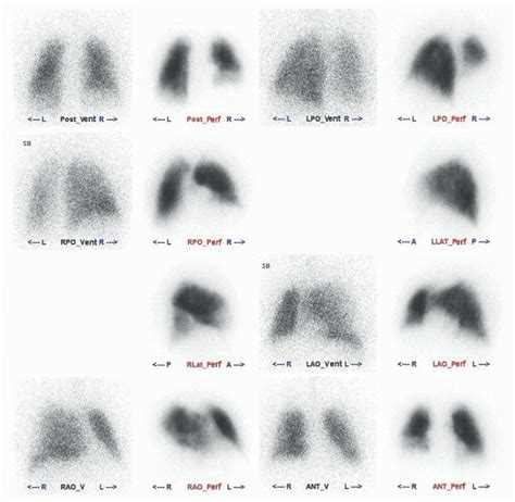 Modified Pioped Ii Criteria Chart Automated Lung Outline Reconstruction In Ventilation