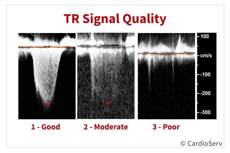 Unable To Estimate Rvsp On Echo Is That Something That Happens R
