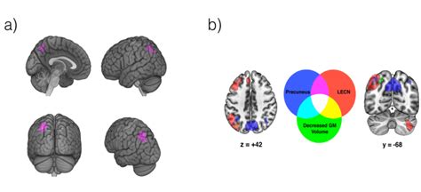 Voxel Based Morphometry Results And Overlap With Intrinsic Functional Download Scientific