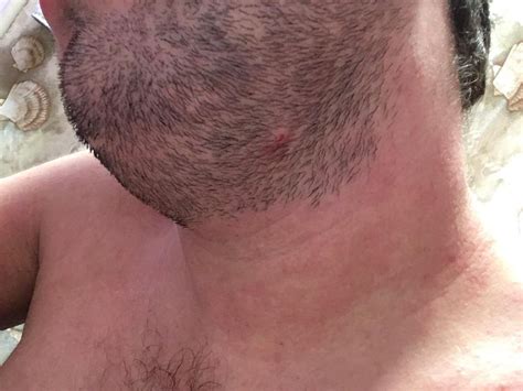Angry Infected Hair Follicle Pulled From My Beard Oc R Popping