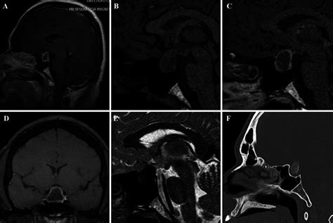 Pituitary Cryptococcoma In An Immunocompetent Patient With Panhypopituitarism Illustrative Case