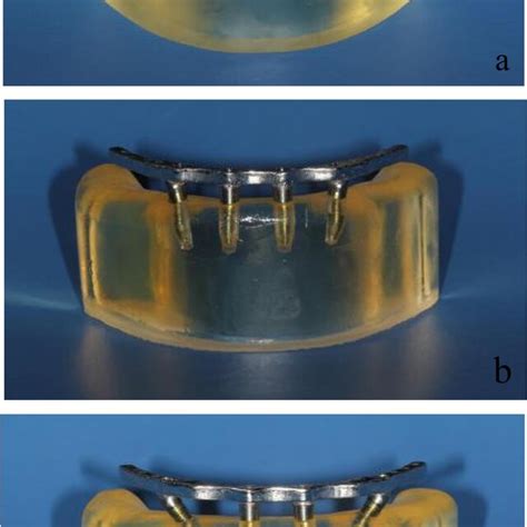 Stress Distribution Around The Distal Implants Of The All On 4 Download Scientific Diagram