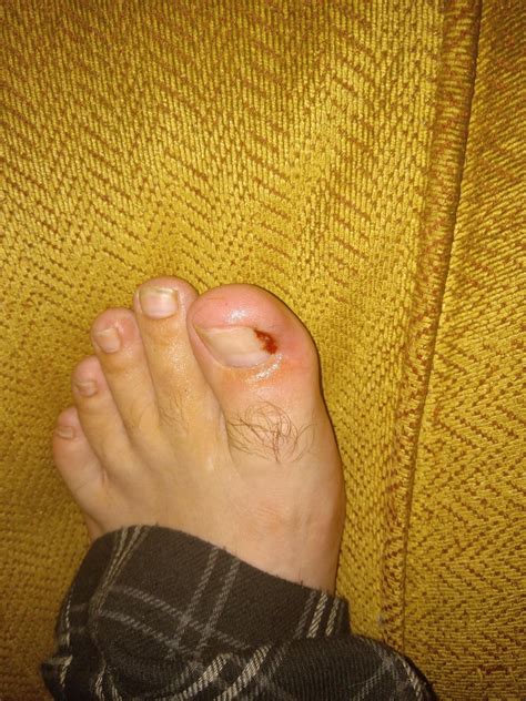 Removing My Own Ingrown Toenail R Ingrown Toenails