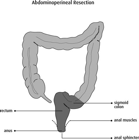 Abdominoperineal Resection Procedure Causes And Recovery