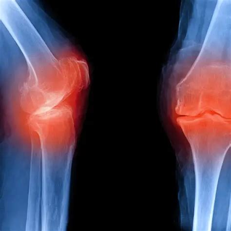 早期骨关节炎你了解多少？ 知乎