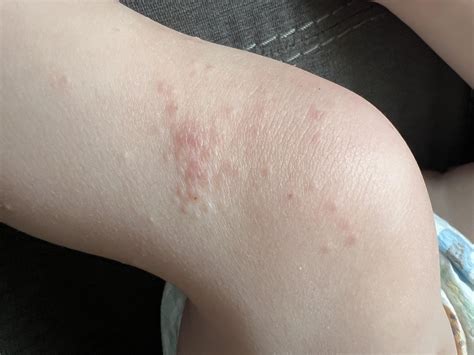 Rash Wont Stop Spreading And No Ointments Working Rdermatologyquestions