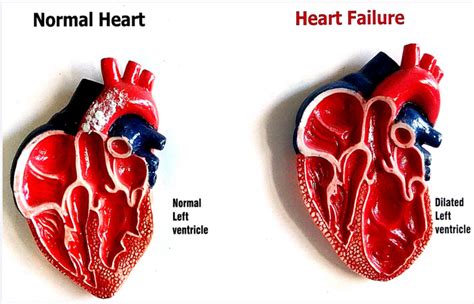 What Is Heart Failure Dr Rahul Sawant