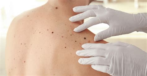 El Melanoma Cada Vez Más Frecuente Y Peligroso También Protagonista