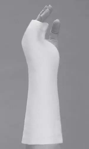 Ulnar Gutter Cast