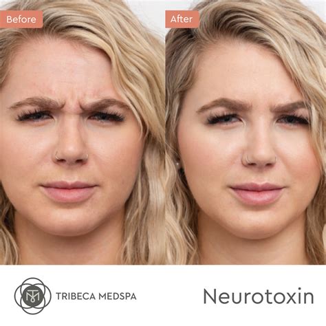 Botox Transformations Before And After Secrets Unlocked