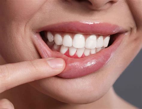 Inflamed Gums Causes Treatments For Gum Swelling