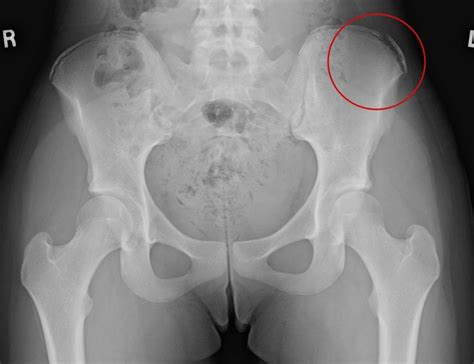 Iliac Apophysitis Sports Medicine Review