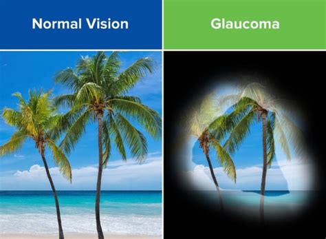 What You Need To Know About Glaucoma Dhruveyecare
