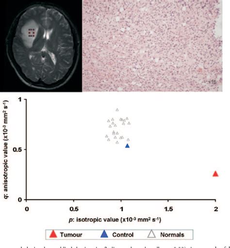 Figure 1 From Improved Delineation Of Glioma Margins And Regions Of Infiltration With The Use Of