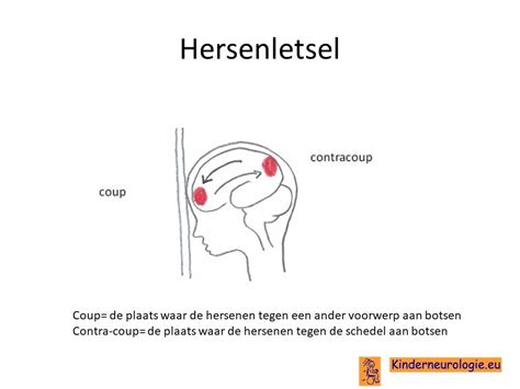 Hersenschudding Kinderneurologie