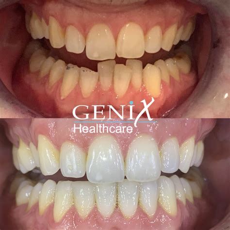 Clear Aligners Genix Healthcare