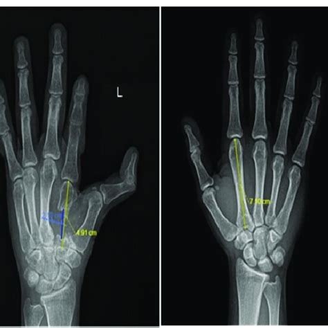 Anterior View Of The Left Hand Metacarpal External Fixator Download