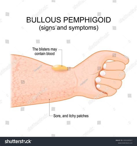 Bullous Pemphigoid Autoimmune Pruritic Skin Disease Stock Vector