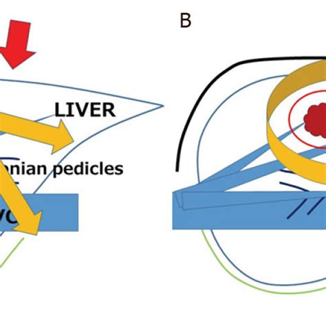 Open A And Laparoscopic B Repeat Liver Resections The Directions Download Scientific