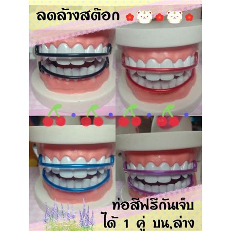 รีเทนเนอร์ไร้เหงือก โอริ่ง เครื่องประดับแฟชั่น แพค 1คู่ บนล่าง งาน 6ปุ่ม เลือกสีได้ Dragon