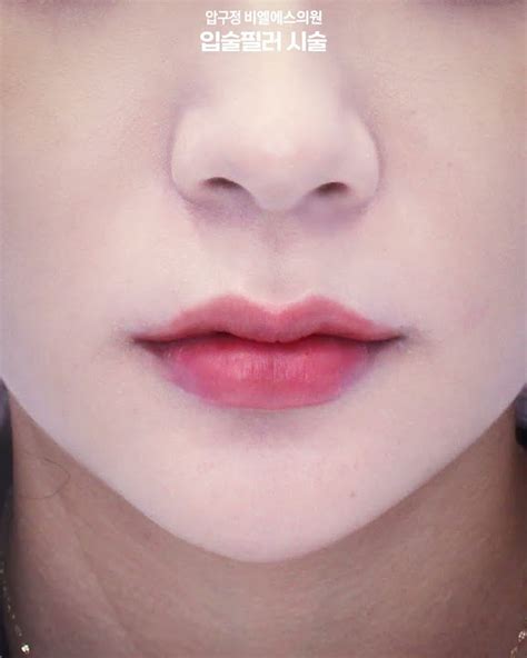 입술이 못생겨서 고민이라면 입술필러 해야지~ Youtube