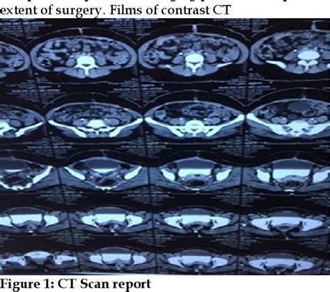 Figure 1 From A Case Report Of Primary Ovarian Mucinous Adenocarcinoma