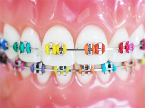 Braces Colors Ideas