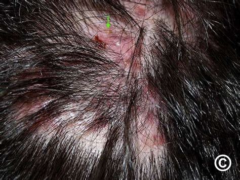 Folliculitis Scalp
