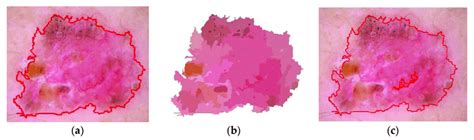 A Elm Image And Lesion Contour B Statistical Region Merging Srm