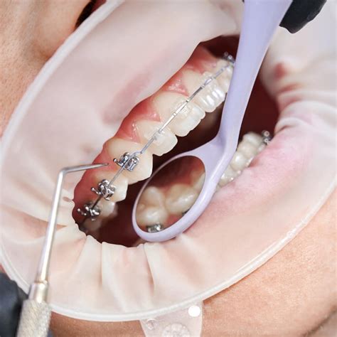 5 Types Of Braces Which One Is Best For You Dental Home