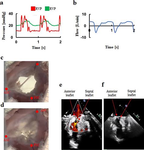 A Tissue Silicone Integrated Simulator For Right Ventricular Pulsatile Circulation With Severe