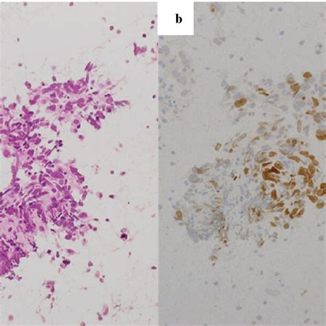A Computed Tomography‐guided Biopsy Specimen From The Left Lower Lobe