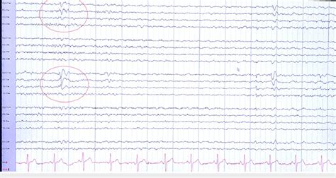 Abnormal Eeg Due To Focal Slowing And Occasional Spike And Wave