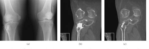 Figure 3 From Synostosis Of The Proximal Tibiofibular Joint Semantic Scholar
