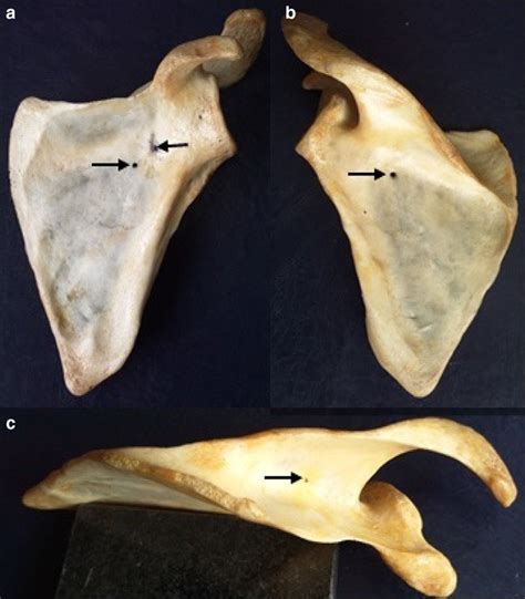 Infraspinous Fossa