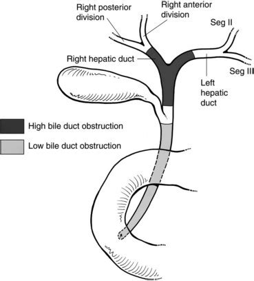 Cancer Of The Bile Ducts Interventional Techniques In Hilar And