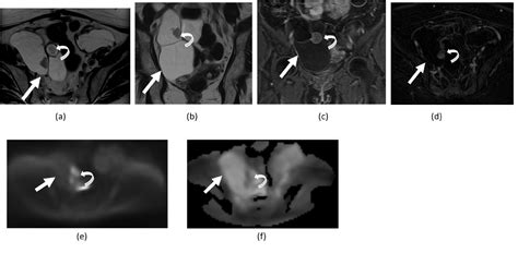 Figure 16 From Utility Of The Diffusion Weighted Sequence In