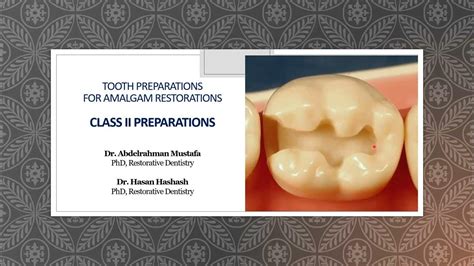 Class Ii Occlusal Access Tooth Preparations For Amalgam