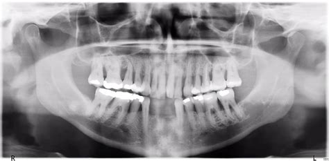 Ch N O N H Nh Nh Nha Khoa B Ng Phim Panorama Minh Tuan Dentist